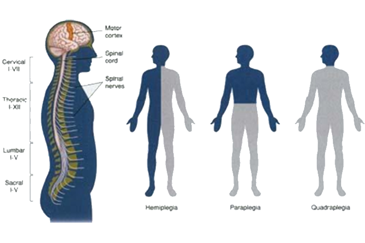 Hemiparesis What It Is Causes Symptoms Treatment Types 48 OFF Hemiparesis What It Is Causes Symptoms Treatment Types 48 OFF